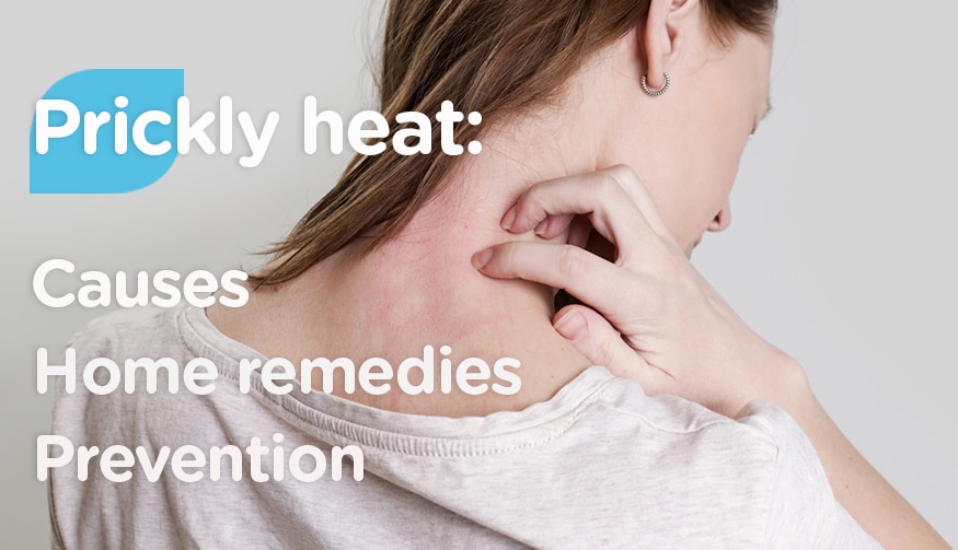 Prickly heat (heat rash)- Causes, home remedies and preventions ...